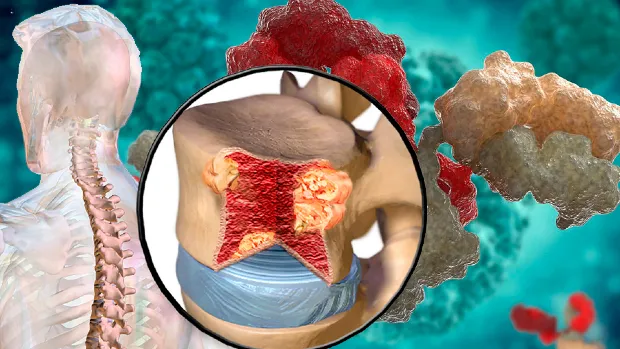 El Mieloma Múltiple afecta a los mexicanos antes que en el resto del mundo